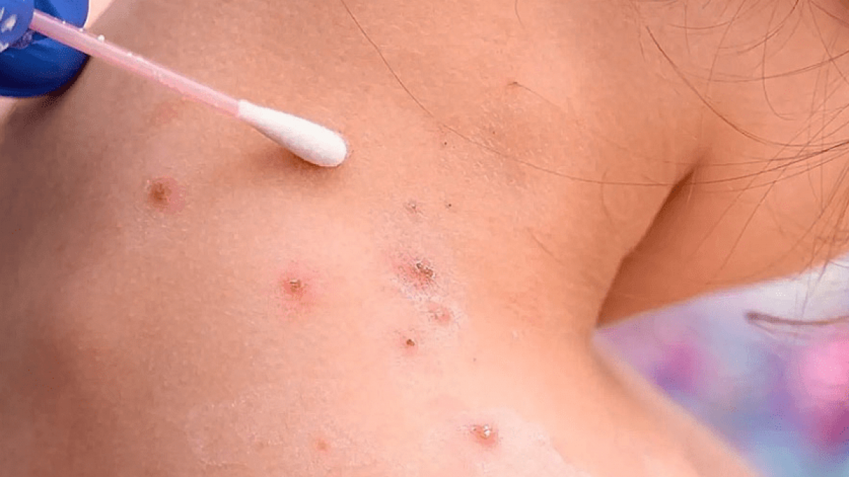 Ascienden a 93 los casos confirmados de viruela del mono en Ecuador