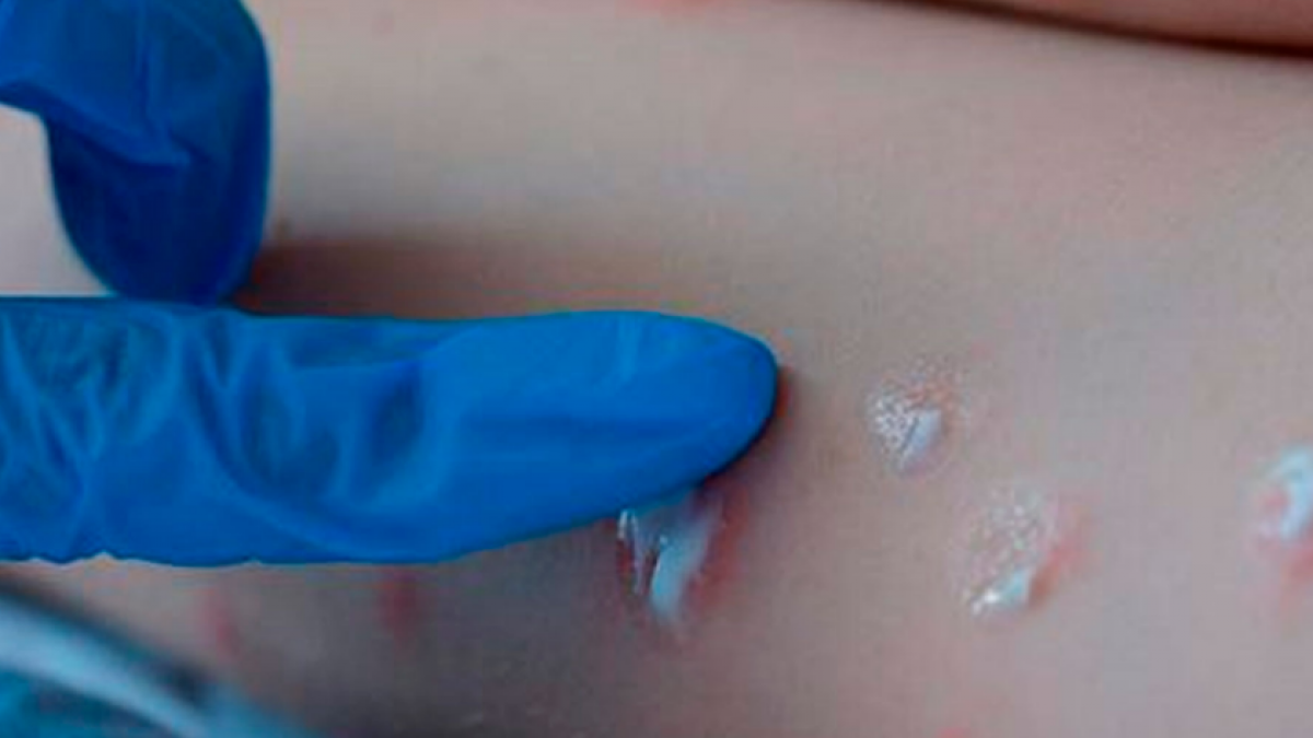 ¿Qué pasó con la viruela del mono en el Ecuador?